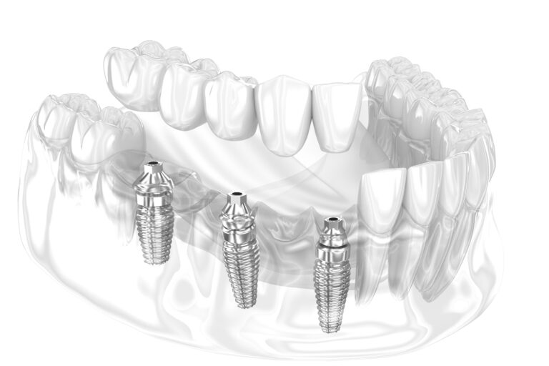 Securing Partial Dentures With Dental Implants | Conroe, TX